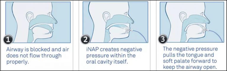Anti-Snoring Sleep Apnea Device - SMIT Medical